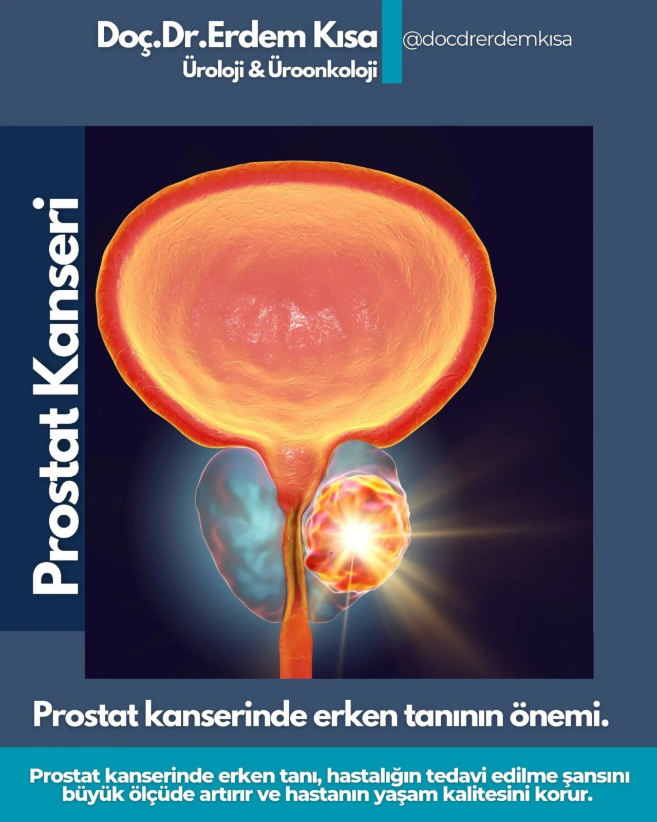 Prostat Kanseri - Doç. Dr. Erdem Kısa